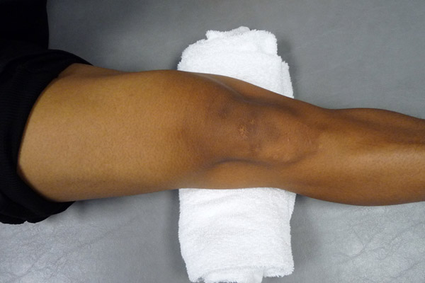 A Guide to Early ACL Rehabilitation - New England Return to Sport Center